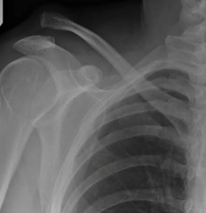 Acromioclavicular joint dislocation
